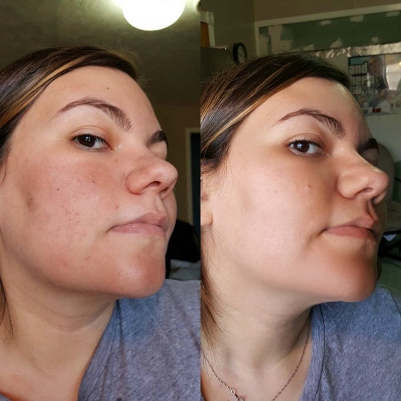 Chemical Peel Vs Dermaplaning Urban Oasis Nashville TN Chemical Peel Vs Dermaplaning Urban Oasis Nashville TN
